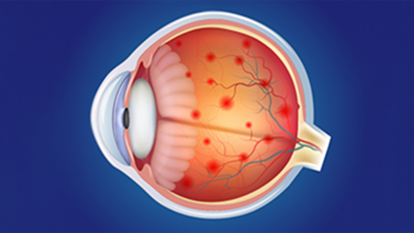 Retinal Diseases | Boehringer Ingelheim