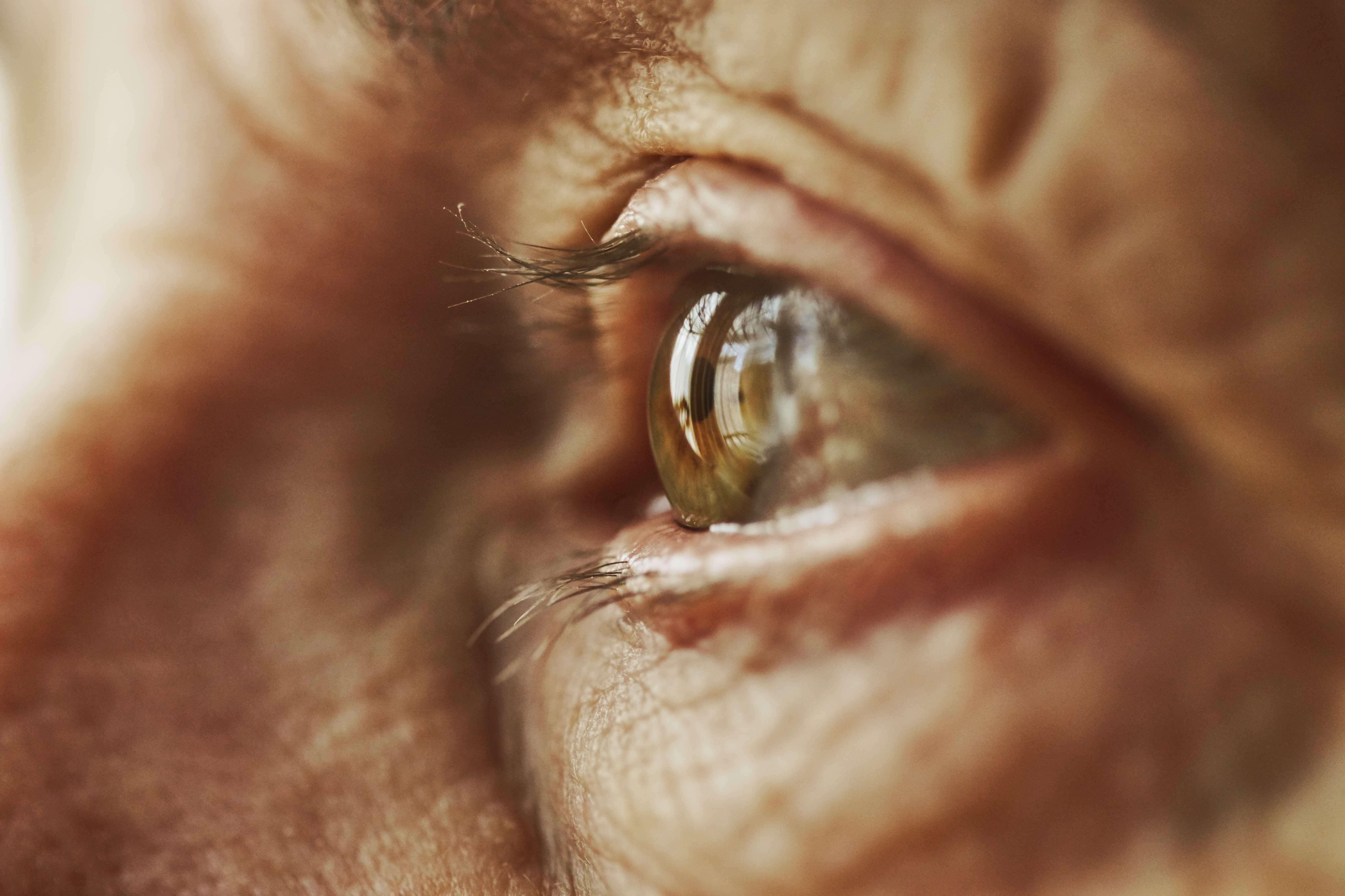 Neovascular AMD (wet AMD)