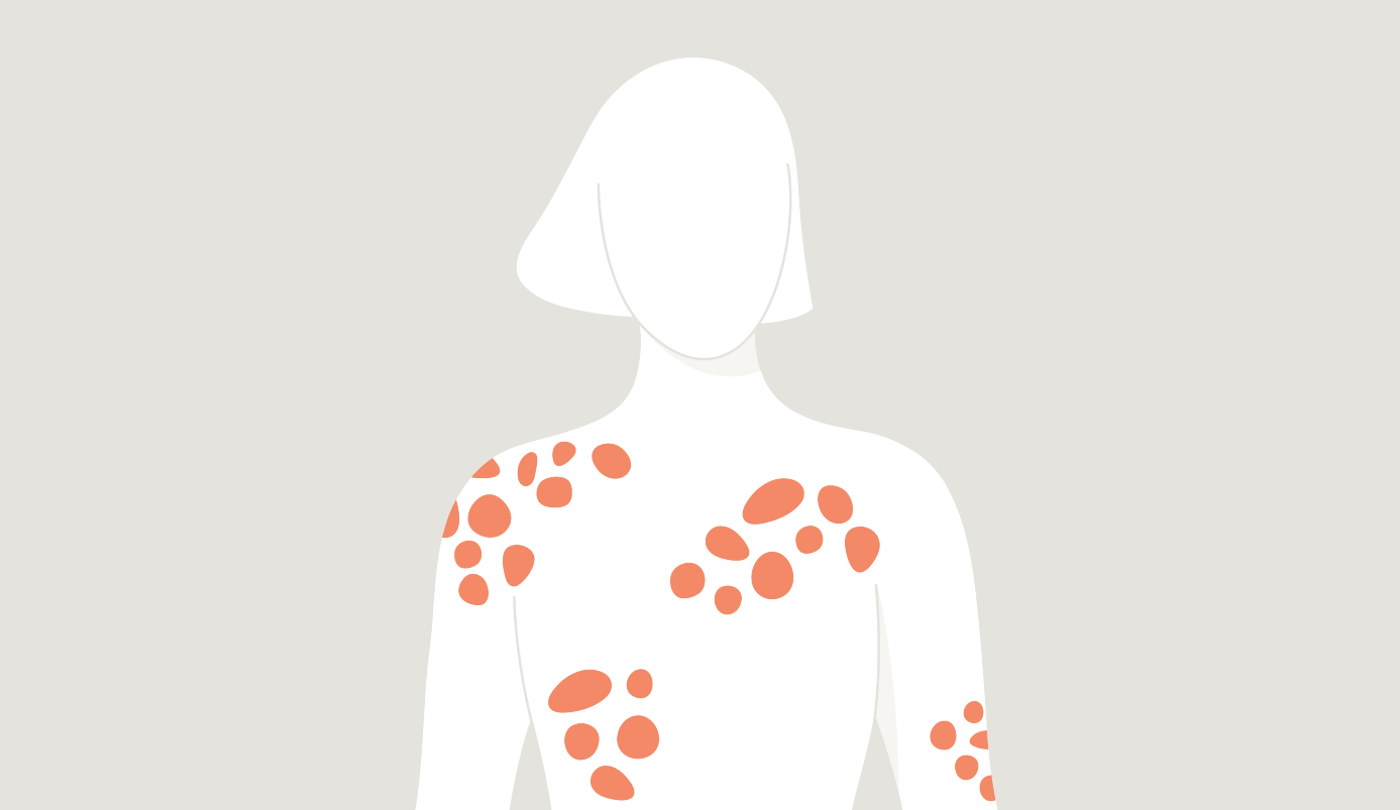 The chronic nature of generalized pustular psoriasis | Boehringer Ingelheim