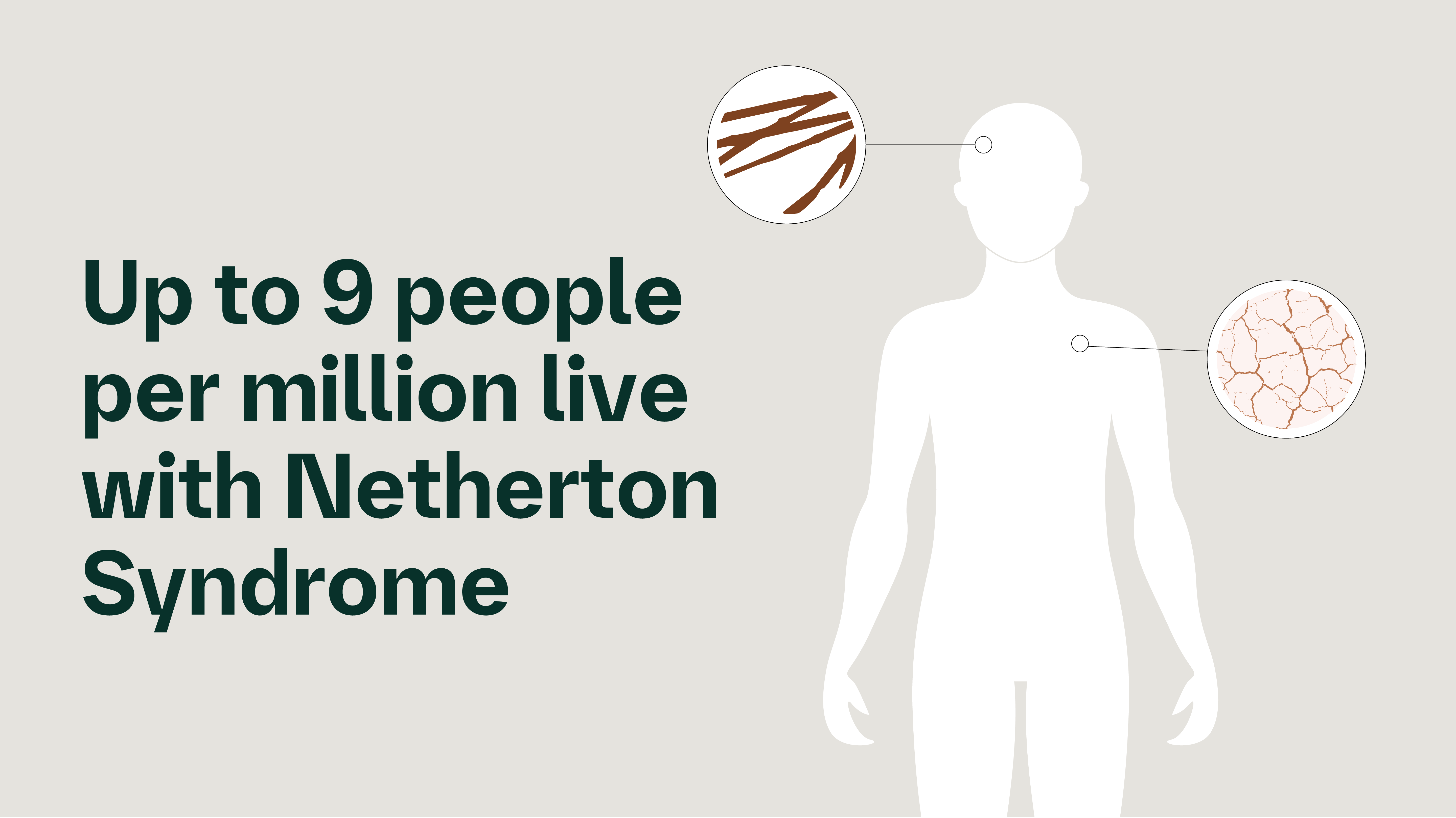 Netherton Syndrome | Boehringer Ingelheim