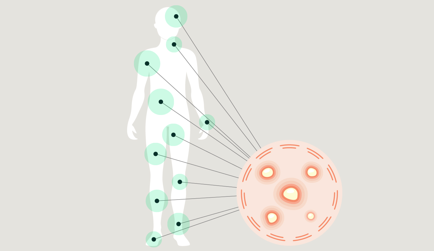 What is Pyoderma Gangrenosum? | Boehringer Ingelheim