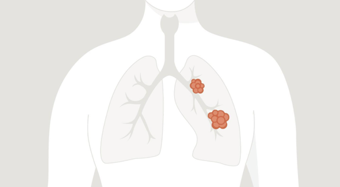 Comprendre le cancer bronchique non à petites cellules (CBNPC ...