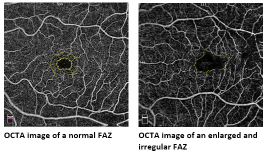 Research in Diabetic Macular Ischemia | Boehringer Ingelheim