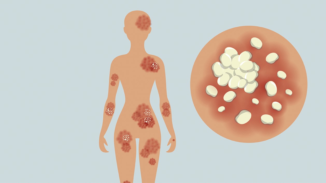 Psoriasis pustuleux généralisé | Boehringer Ingelheim